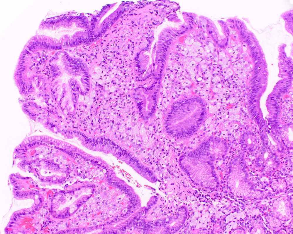 Gastric Xanthoma