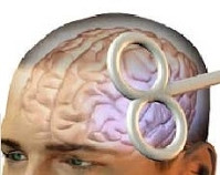 Butterfly coil for Curatron 3D | curatronic