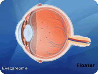 Floaters