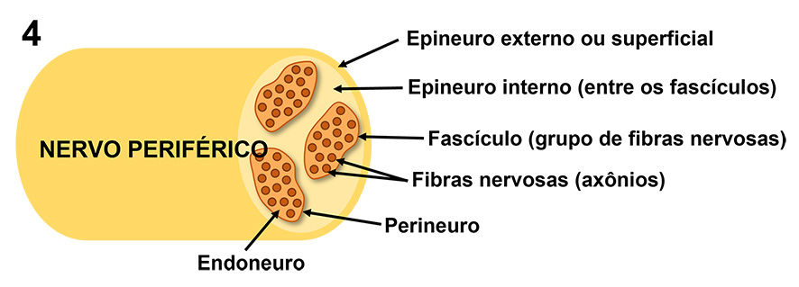 Hamartoma lipofibromatoso do nervo mediano