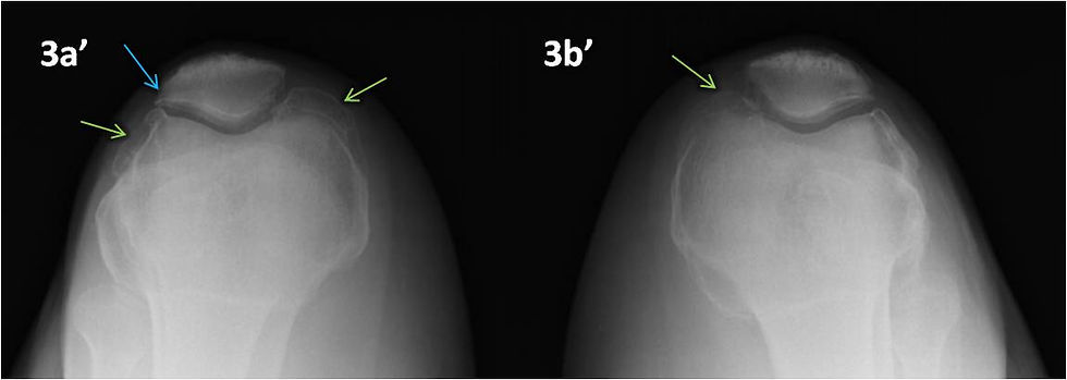 Osteoartrite do joelho