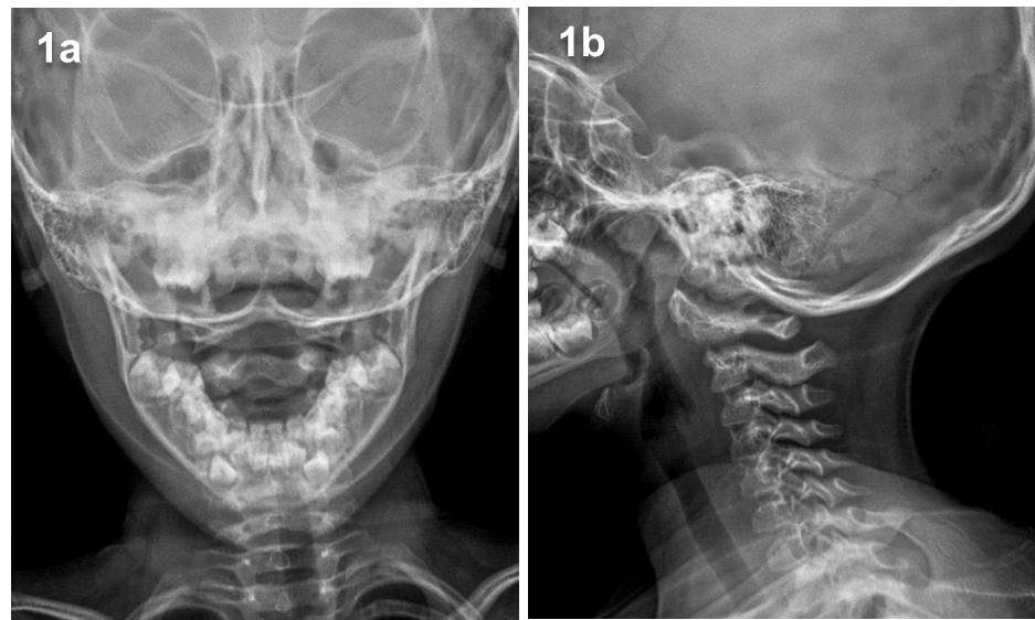 Coluna Vertebral Plana