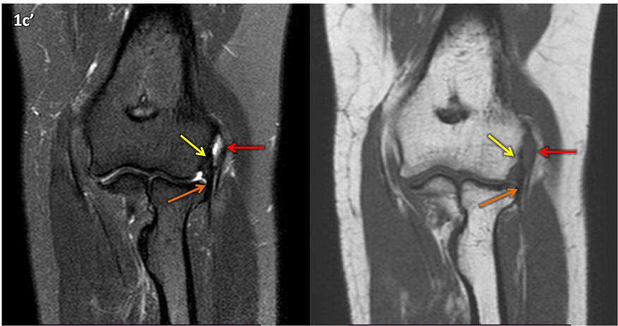 Epicondilite lateral