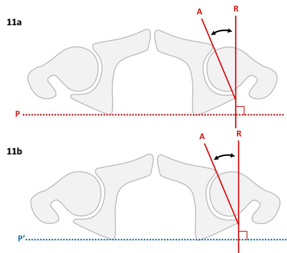 Impacto femoroacetabular tipo "pincer"