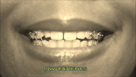 Jaw Wiring For Broken Jaw