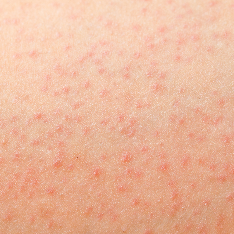 Eosinophilic folliculitis