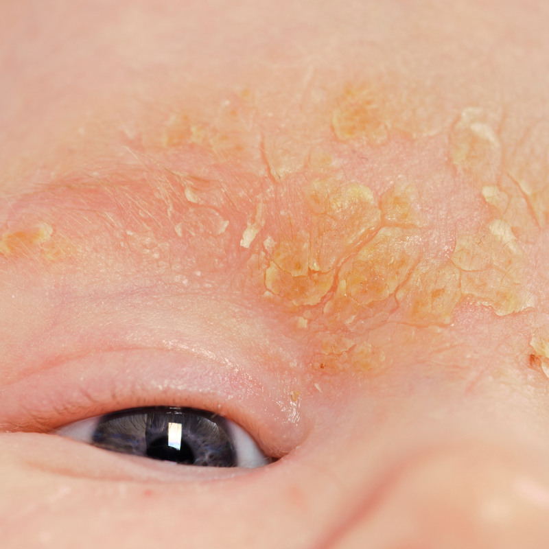 Seborrheic Dermatitis