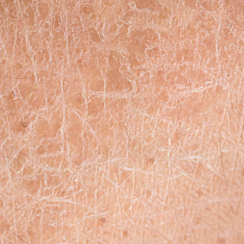 Ichthyosis vulgaris | kinderderm