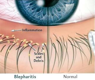 Eyelash Extension After-Care: Preventing Lash Mites and Blepharitis