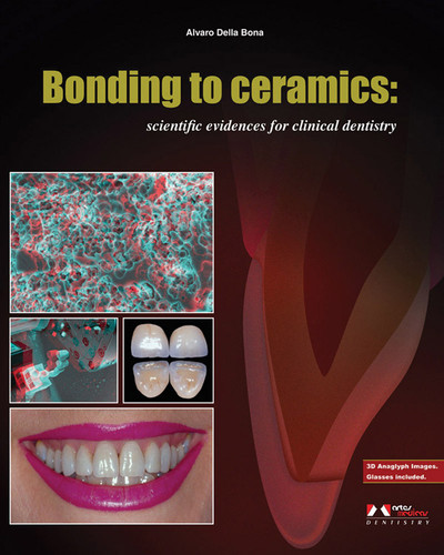 Bonding to Ceramics: Scientific Evidences for Clinical Dentistry ...