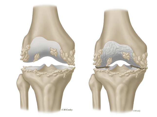 Artrosis de Rodilla | CORE