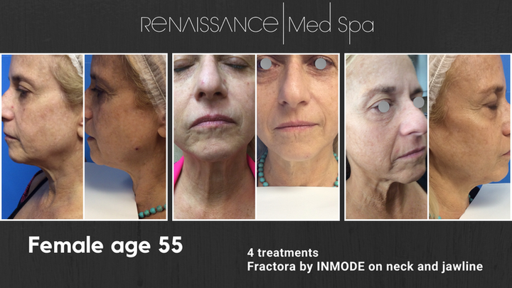 Renaissance Med Spa | Before And After Photos