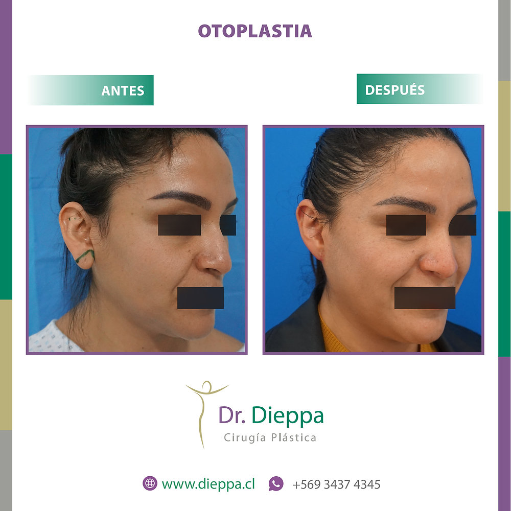 Antes y Después de una Otoplastia