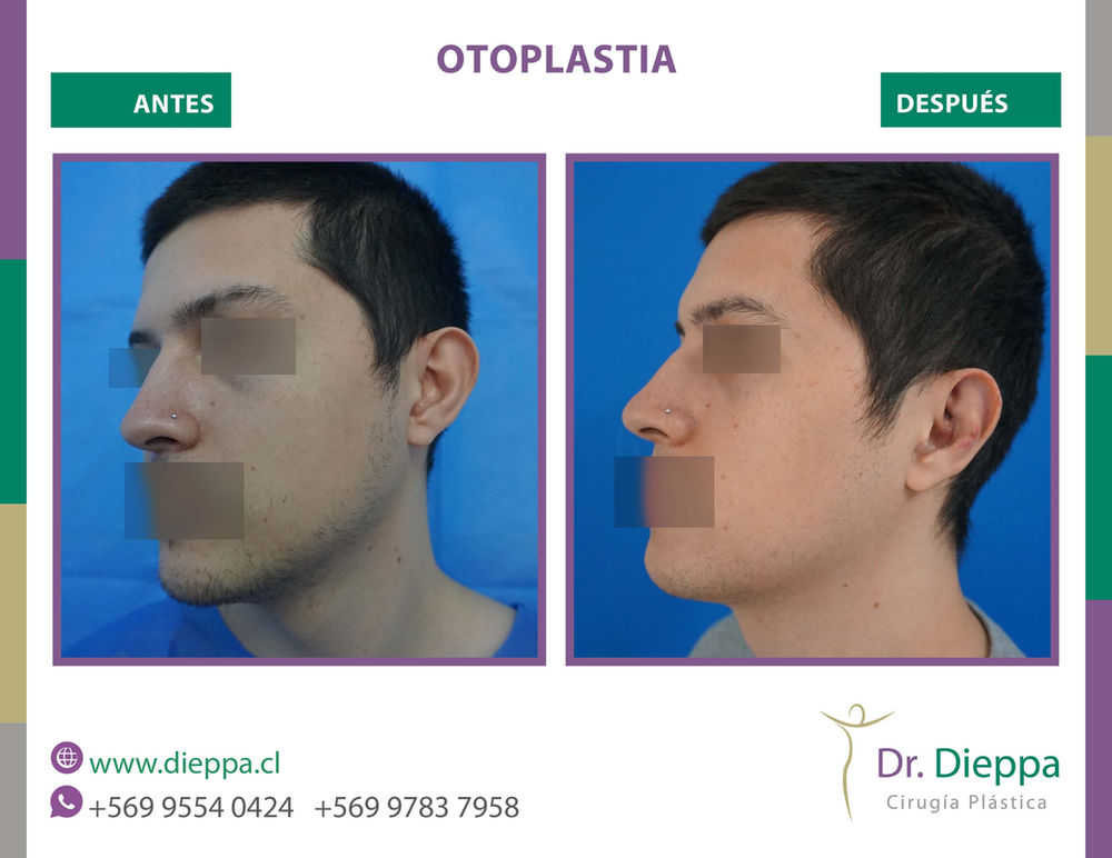 Otoplastia