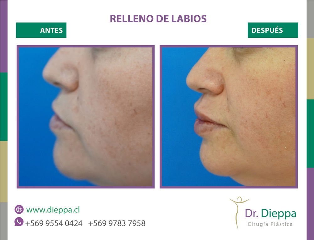 Aumento de labios