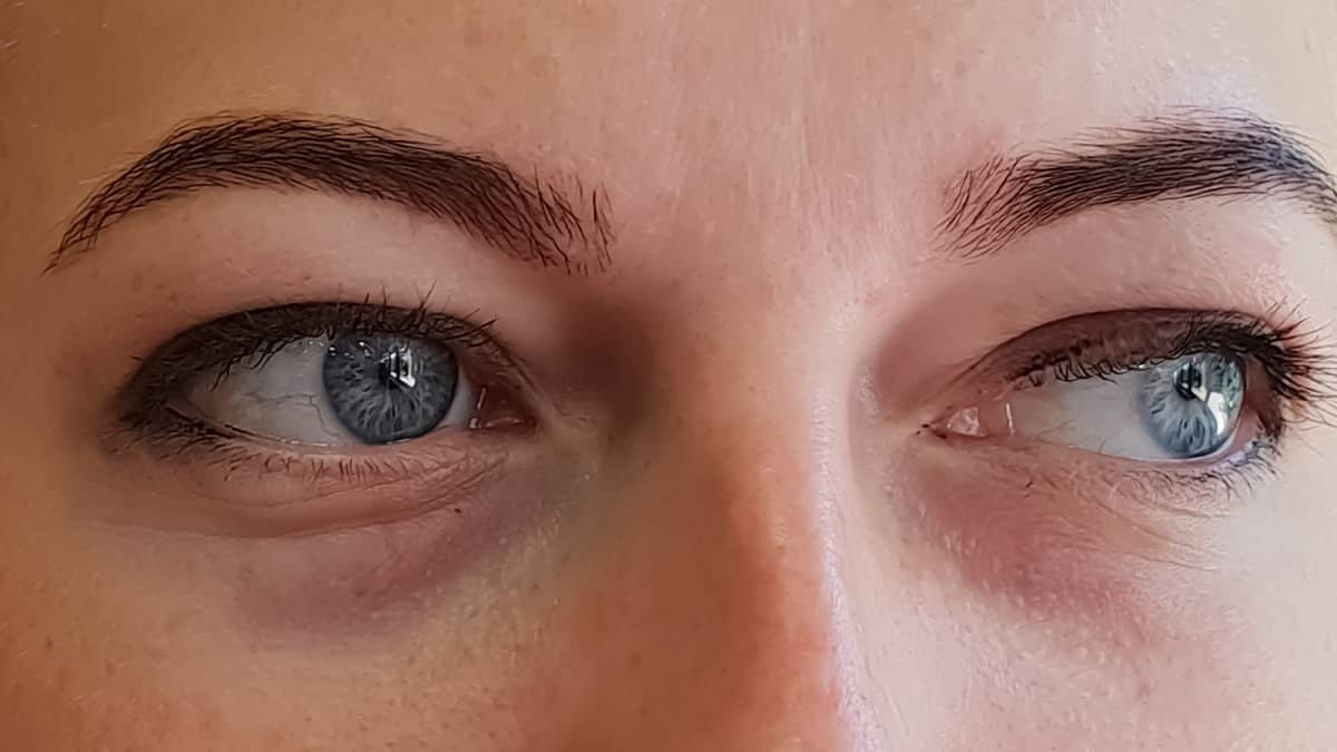 Classification and Characteristics of Periorbital Hyperpigmentation