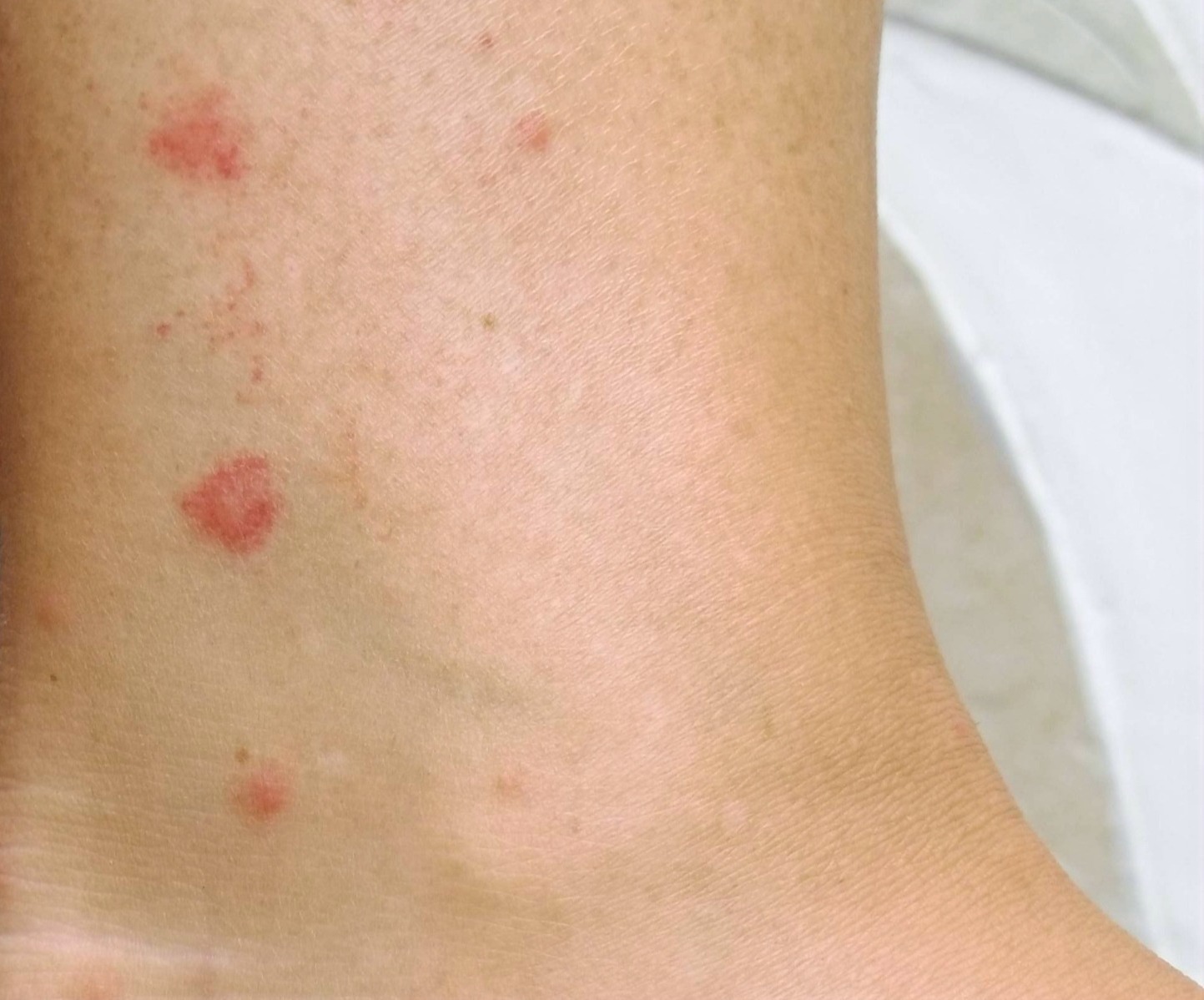Bed bug bites: all you need to know