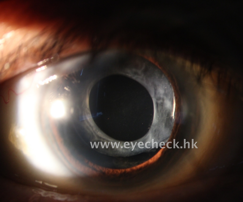 Anterior capsular phimosis