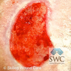 Granulation Tissue Wound Granulation Tissue Pathology Made Simple