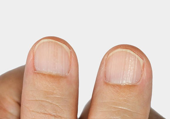 Ridged nails - What are they & What does it mean?