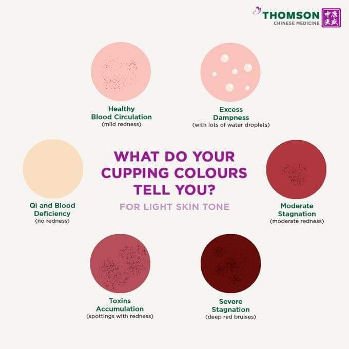 Myofascial Dry Cupping: What is it and how does it work? – Top To Toe ...