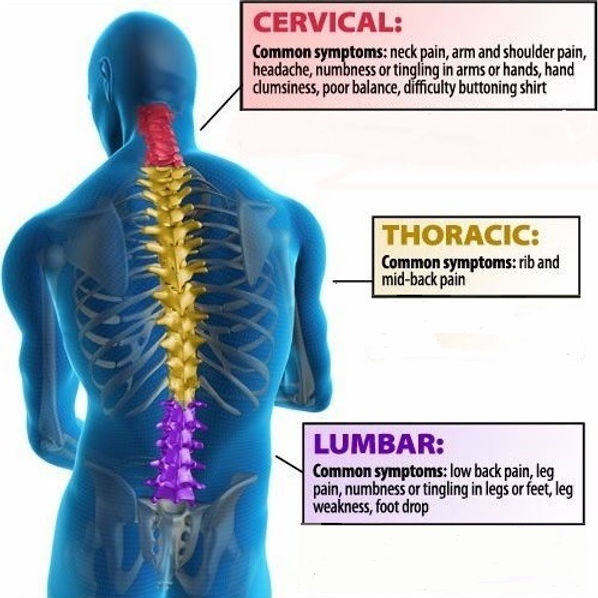 Postlaminectomy Syndrome Glenn goldstein do postlaminectomy-syndrome-glenn-goldstein-do
