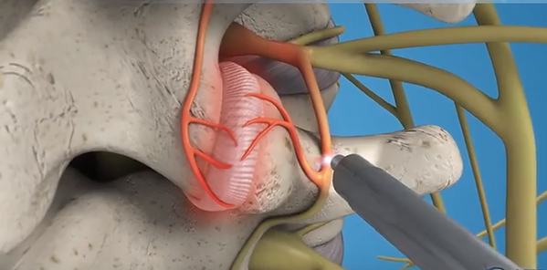 Endoscopic Rhizotomy|Queens NYC|Endoscopic Rhizotomy