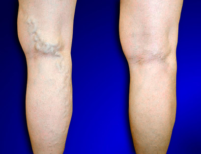 Varis Vein Institute | Vein Treatment | Variscose & Spider | Ohio ...