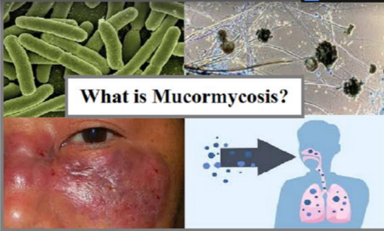 Mucormycosis