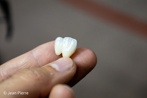 Porcelain Fused to Zirconia | Jean Pierre