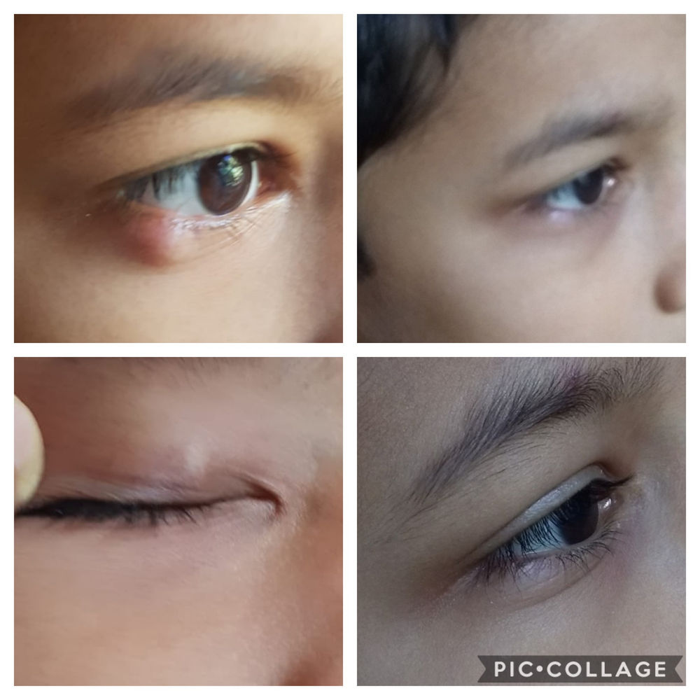 Recurrent Chalazion - No surgery needed.... Homeopathy healed