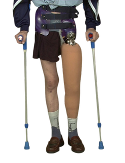 hip disarticulation prosthesis socket