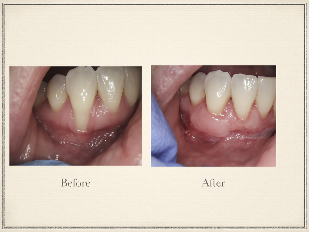 Tissue Grafting for gum recession