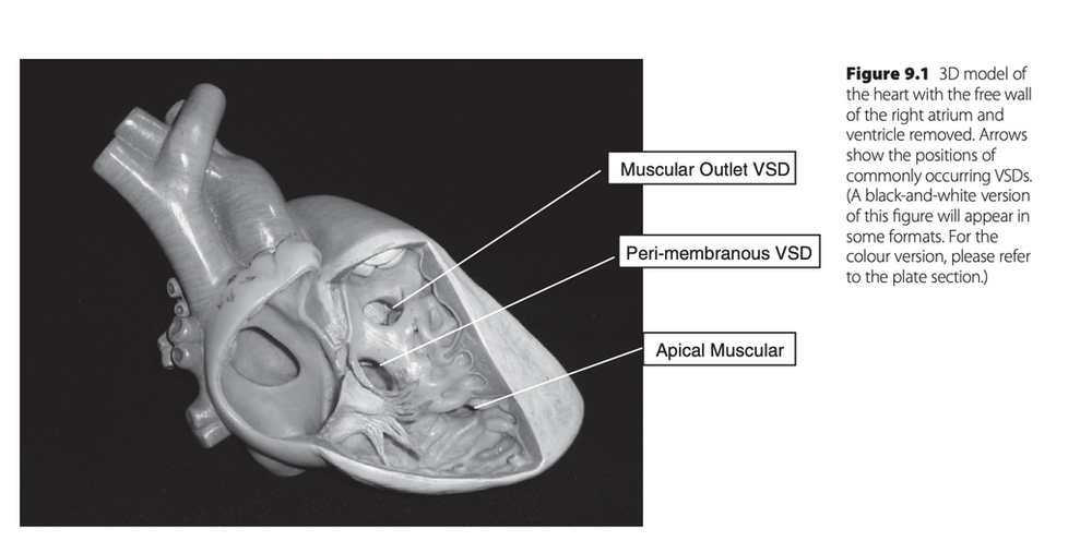 Defeito do septo Interventricular