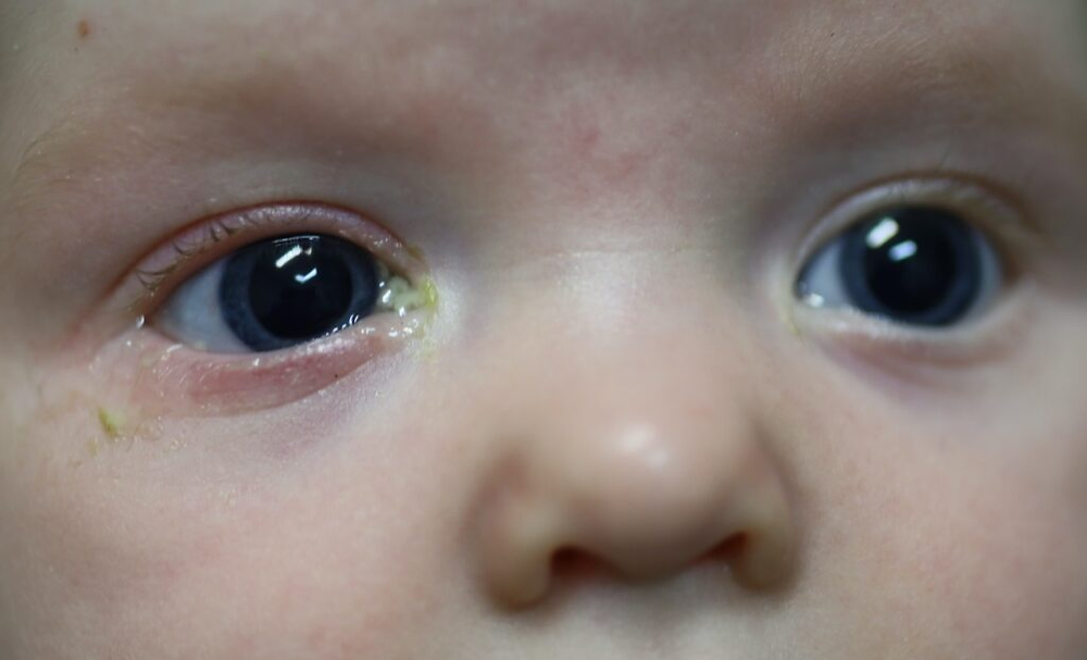Parent’s Guide to Common Eye Problems in Babies (0-18 Months)