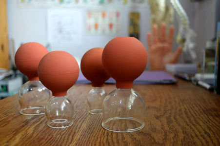 Cupping Jan Still Acupuncture Warwick Medical Treatment