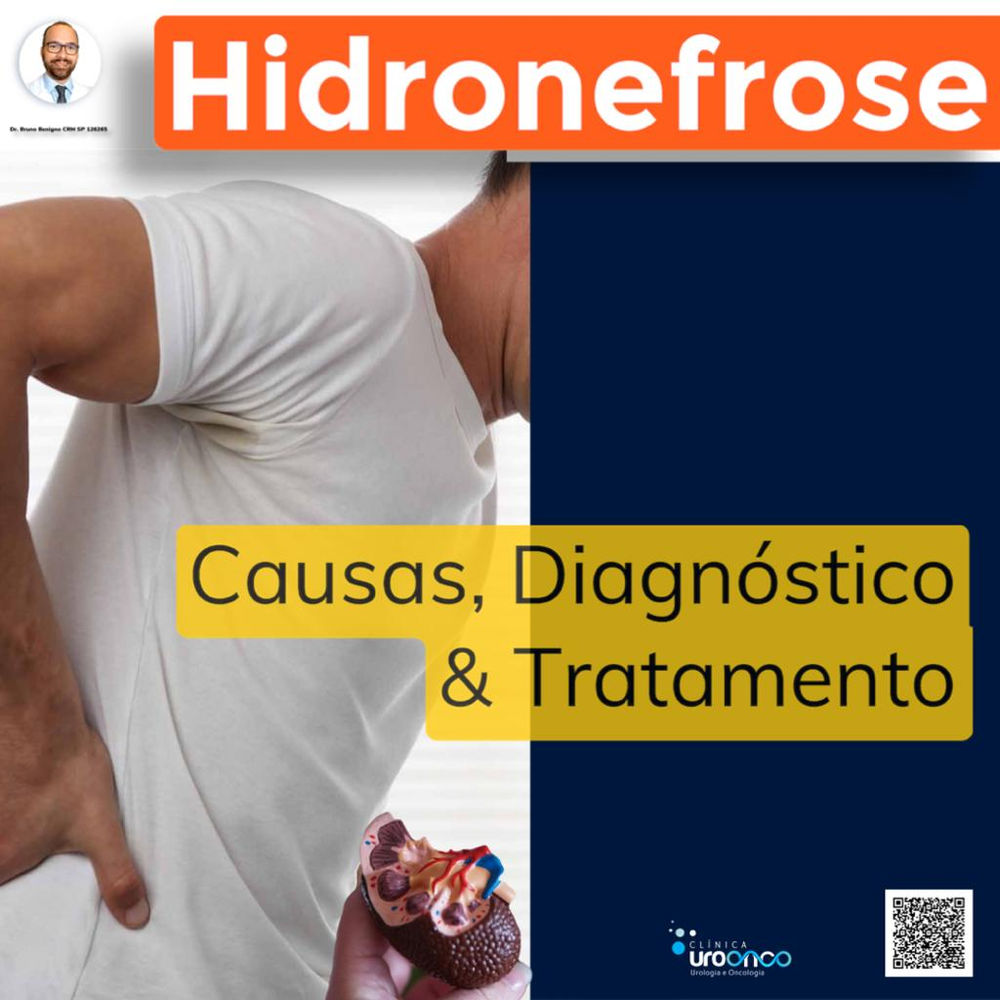 O que é a hidronefrose? - Causas, diagnóstico e tratamento.