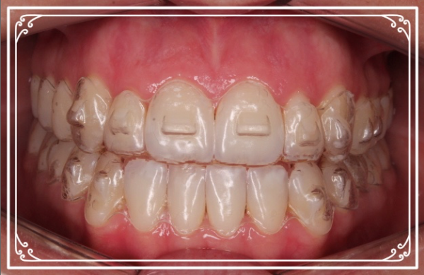 Clear Aligners - A great approach to correct dental arch asymmetries