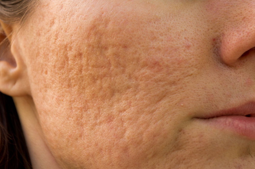 Microcurrent Technology For The Treatment Of Certain Types Of Acne Scars