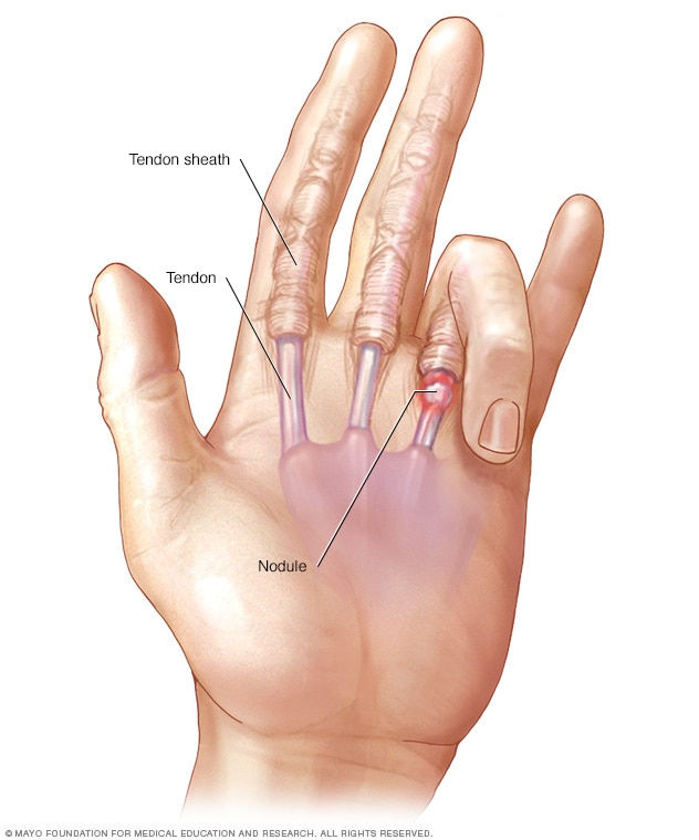 My finger is stuck! (Trigger Finger) My finger is stuck! (Trigger Finger)