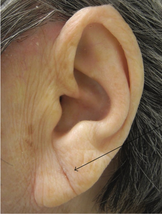 Diagonal Earlobe Crease Predicts Heart Disease