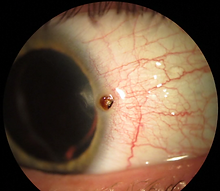 corneal foreign body cpt