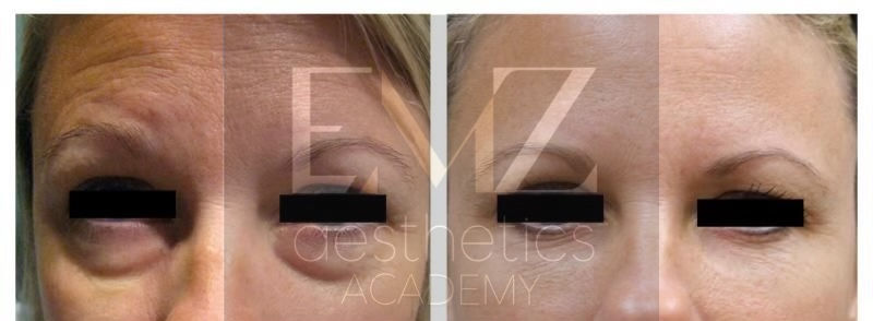 Tear Trough Augmentation