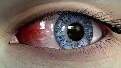 Episclerite | Dott. Stefano Marchi | Oculista