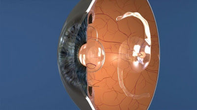 IOL Piggyback | Dott. Stefano Marchi | Oculista