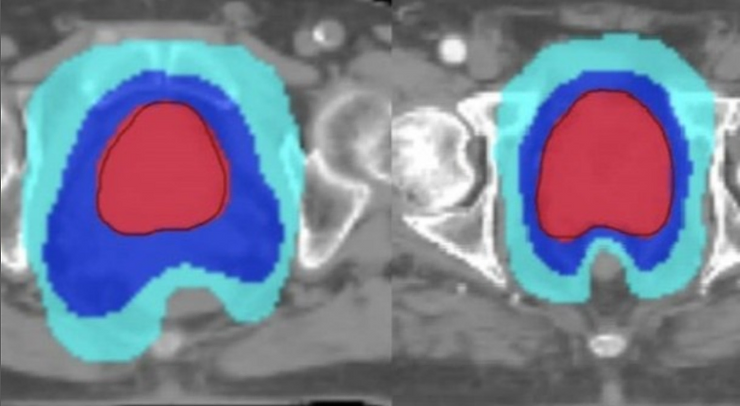 Prostate cancer - The battle between IMRT vs SBRT