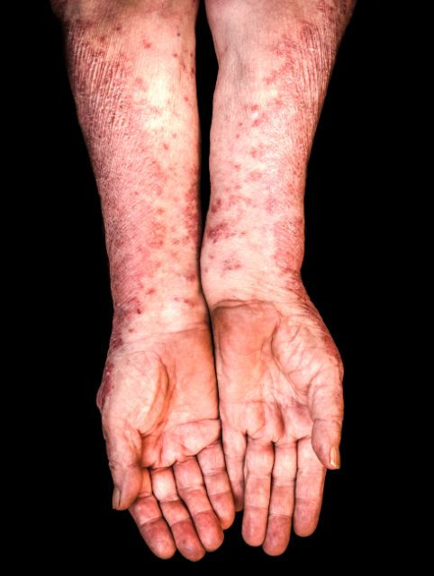 Types of skin diseases All that is important to know