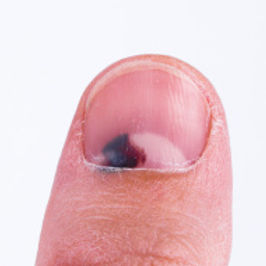 Injury: Bruised Toenail