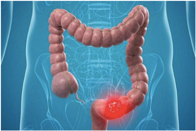 [Little Knowledge] Let's understand what CEA is?