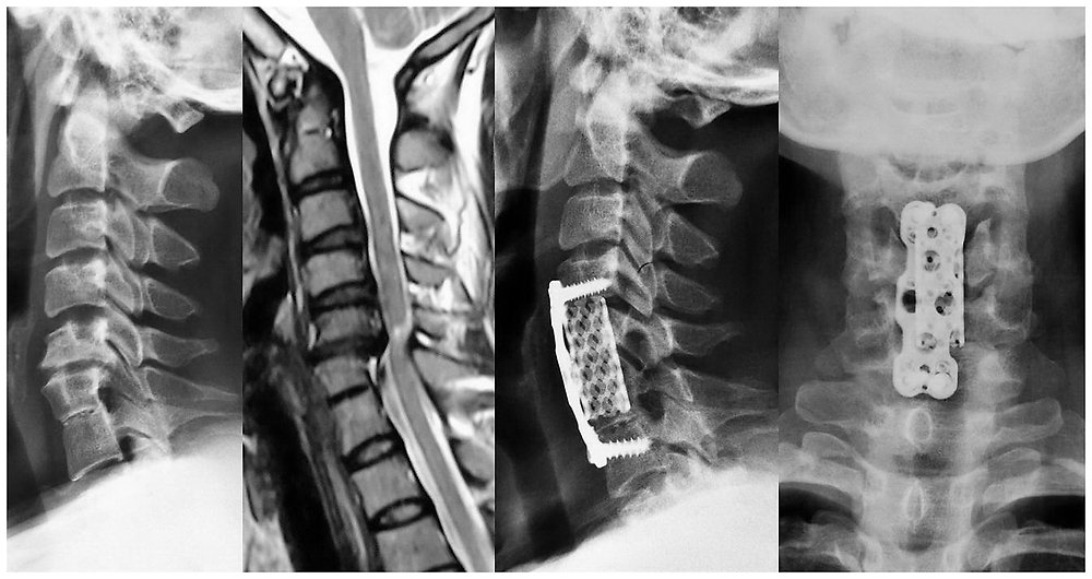 Anterior Cervical Corpectomy and Fusion